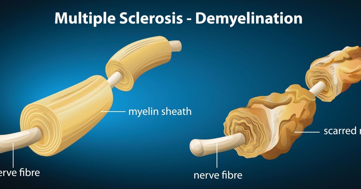 Her finner du nyttig kunnskap om multippel sklerose (MS) - Helsebiblioteket