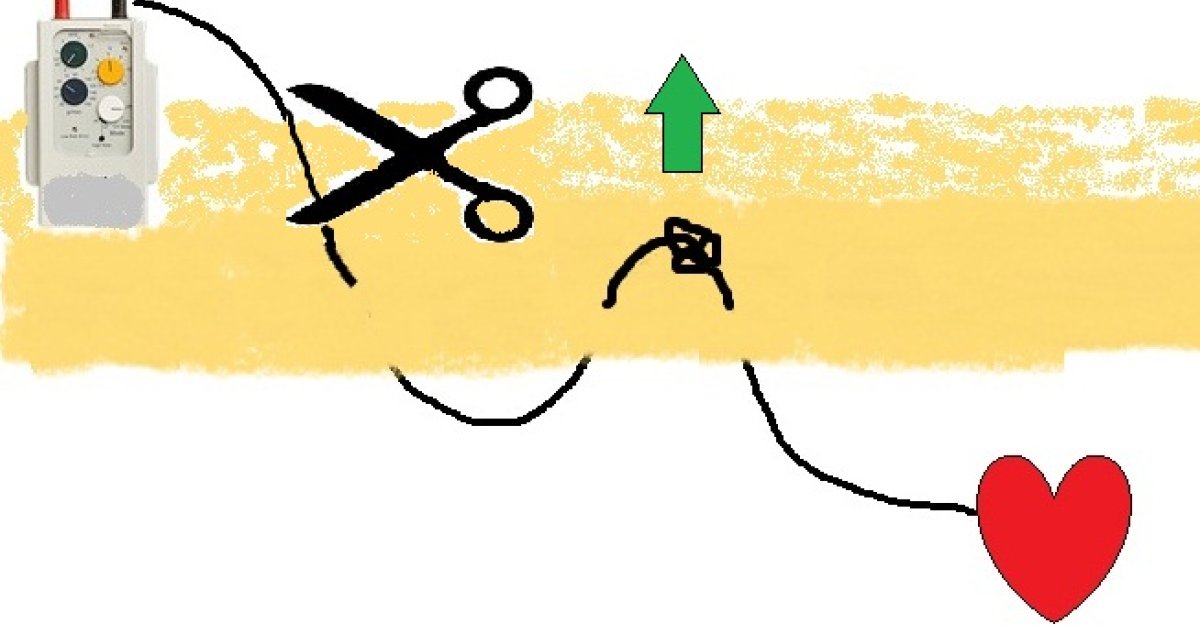 8.23 Fjerning av temporære pacemakertråder - Helsebiblioteket