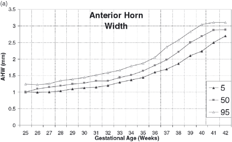 9.6 Posthemoragisk ventrikkeldilatasjon og hydrocefalus - Helsebiblioteket
